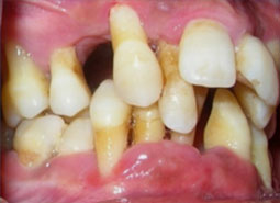 Prise en charge d’une parodontite agressive avancée | Cas clinique