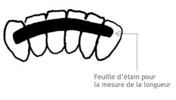 Contention par composite renforcé aux fibres par technique directe ...