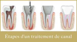 Traitement de canal dentaire de A à Z - Ma santé bucco-dentaire