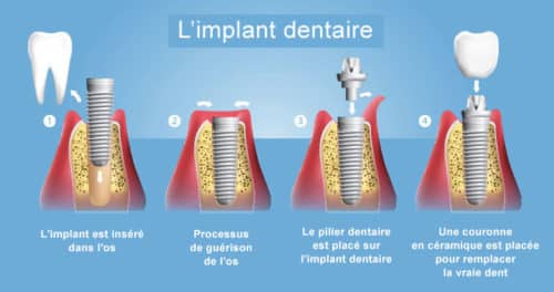 La pose des implants dentaires - Ma santé bucco-dentaire