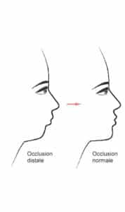 Qu'est-ce que la malocclusion dentaire et comment la traiter