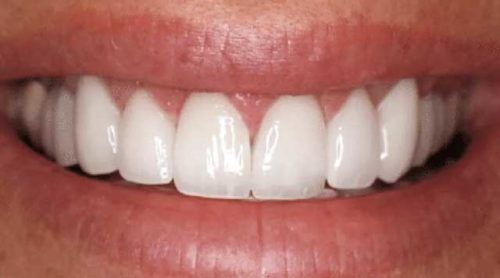 D'où viennent les dents transparentes ? Causes et traitements